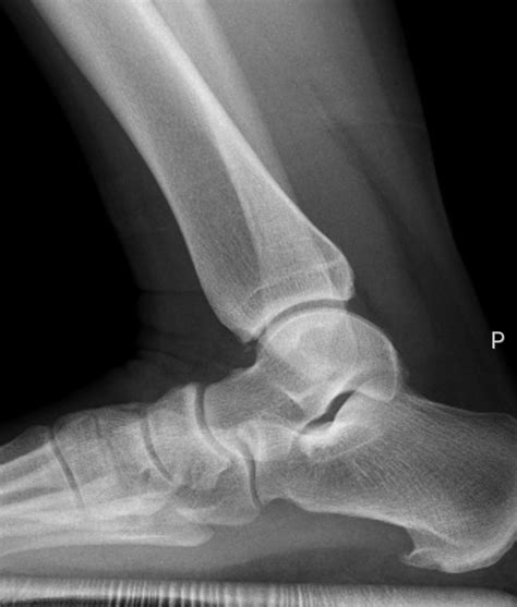 Anterior Ankle Impingement Ankle Foot And Orthotic Centre