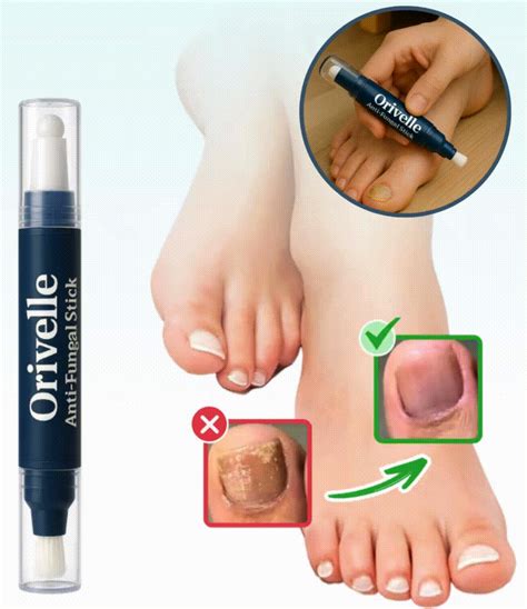 Orivelle Antifungal Nail Pen La Mejor Compra