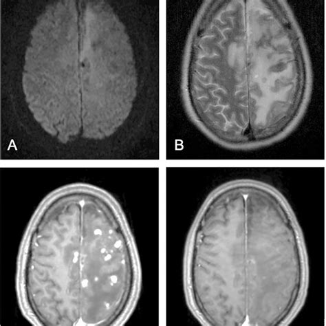 Magnetic Resonance Imaging Magnetic Resonance Imaging Mri Findings