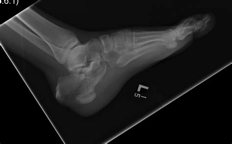 Management Intra Articular Fractures The Bone School
