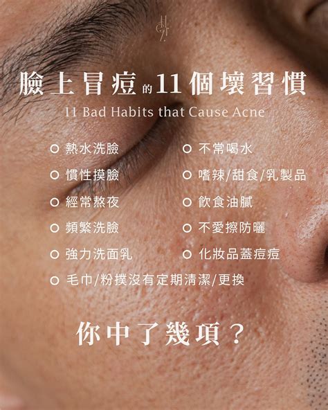 Hérz荷拾｜韓式皮膚管理｜痘痘粉刺清潔 致 我摯愛的mr Bean And Ms Bean Hi 我是痘痘， 常常被你們當作皮膚上的小