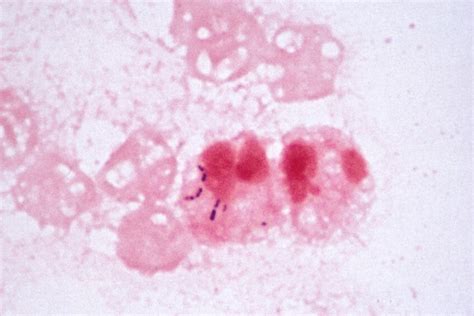 Streptococcus Pneumoniae Gram Stain Csf