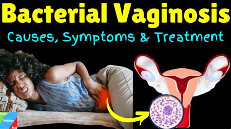 Bacterial Vaginosis BV Symptoms Causes Diagnosis Treatment