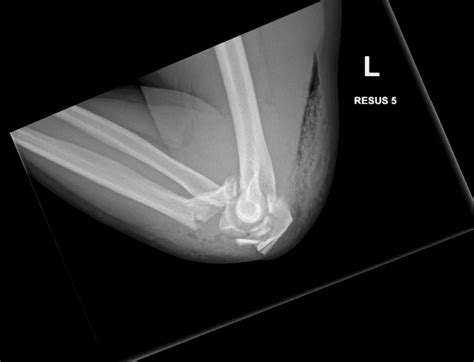 Fractures Around The Elbow Dr Oscar Brumby Rendell Orthopaedic Surgeon