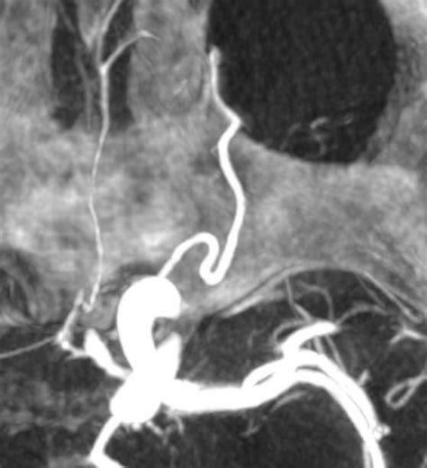 Ophthalmic Artery