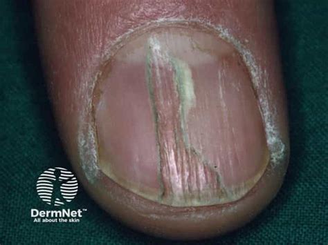 Median Canaliform Nail Dystrophy