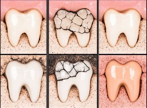 Detailed Close Up Of Damaged Teeth With Decay Dental Problems Stock