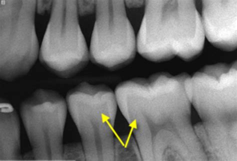 Ch 21 Recognizing Normal Radiographic Anatomy Intraoral Radiographs