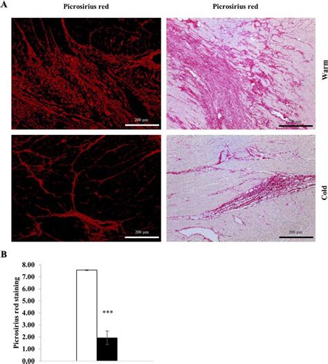 Myocardial Hypothermia Decreases Fibrosis Myocardial Tissue Of The Lv