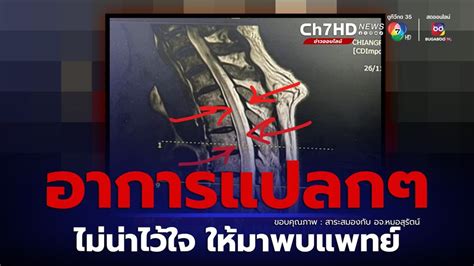 ข่าวเคสยาก วัณโรคไขสันหลัง อจหมอสุรัตน์เตือนวัณโรคยังวนเวียน