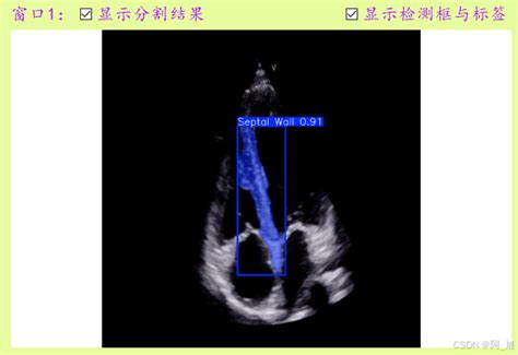 基于yolo11深度学习的心脏超声图像间隔壁检测分割与分析系统【python源码pyqt5界面数据集训练代码】深度学习实战、目标分割、人工智能人工智能阿旭 Damo开发者矩阵