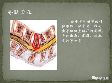 脊髓解剖及脊髓损伤 知乎