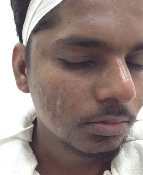 Salicylic Acid Peel Benefits Cost Before And After Results