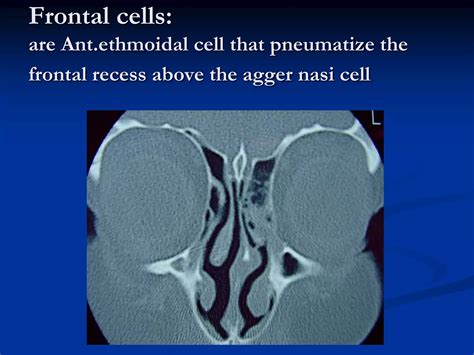Ct Scan Of Nose And Pns Ppt