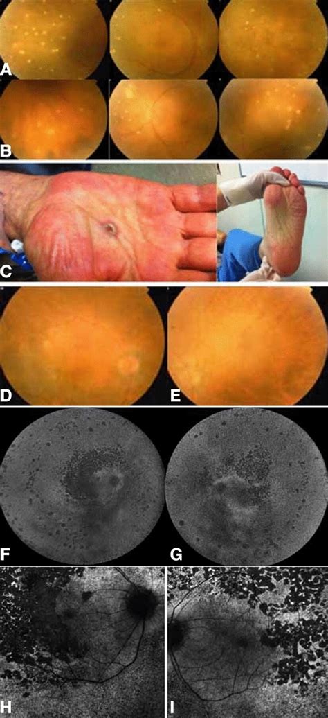 Syphilitic Uveitis Positive Serology In A 60 Year Old Male Patient
