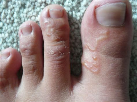 Yeast Infection Yeast Infection Causes Symptoms And Treatments