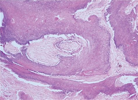 Histological Section Showing Evolution Of Basaloid Cells Into Shadow