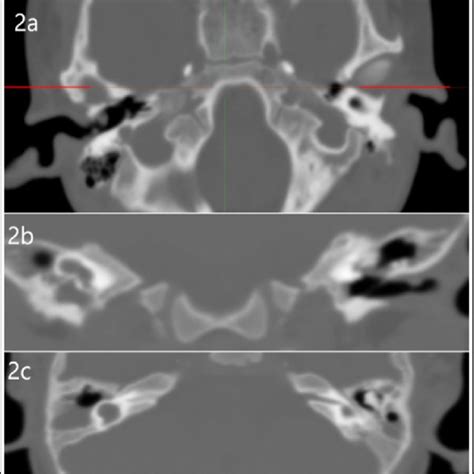 The Average Age At Surgery In The Ossicular Chain Fixation Of And