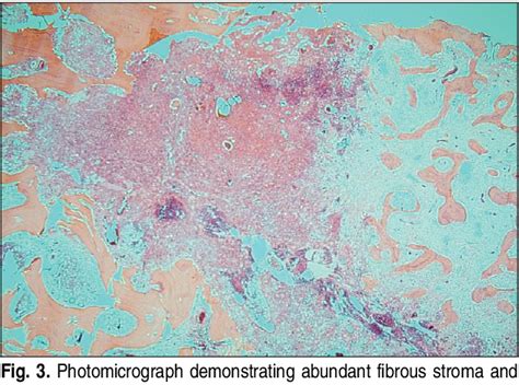 Figure 1 From Fibrous Dysplasia With Aneurysmal Bone Cyst Presenting As