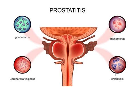Chronic Epididymitis Causes Symptoms Diagnosis Treatment Stdgov Blog