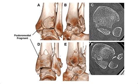 Examples Of The Differing Morphology Of An Avulsion Type Fragment On A