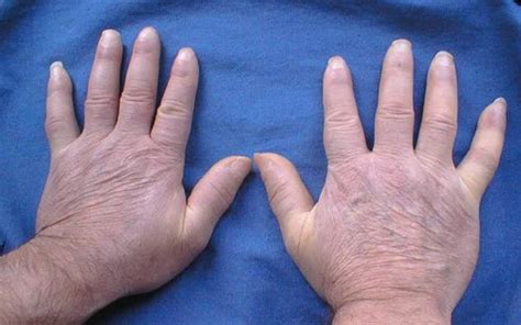 Scleroderma Shedding Light On This Rare Autoimmune Disease Free Malaysia Today Fmt