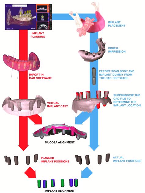 Superimposition Of The Planned And Actual Implants Using A Best Fit