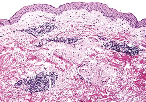 Erythema Annulare Centrifugum Histology