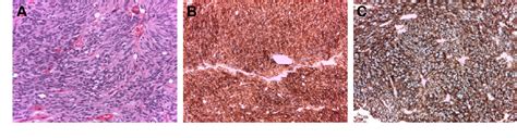 Figure 1 From Inactivity Of Imatinib In Gastrointestinal Stromal Tumors