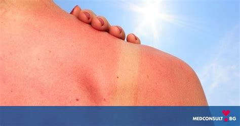 Слънчева алергия — Medconsult Bg