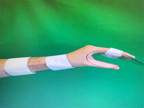 32 Splinting Flashcards Quizlet