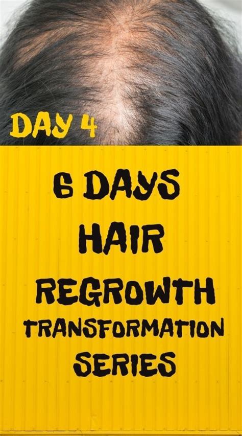 6 DAYS HAIR GROWTH TRANSFORMATION SERIES DAY 4 Hair Growth Hair