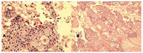 A Cell Block Section Of Low Grade Mucoepidermoid Carcinoma Displaying