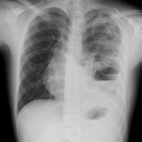 Intraoperative Findings During The Open Window Thoracostomy And Download Scientific Diagram