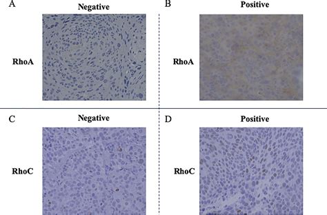 Table 1 From Impact Of Rhoa Overexpression On Clinical Outcomes In