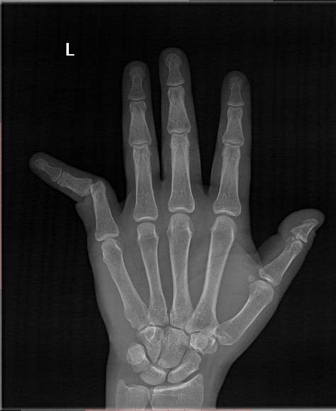X Ray Of Pinky Finger Dislocation