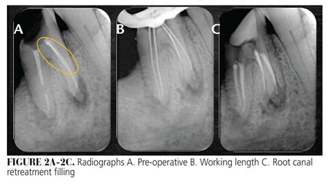 Mastering The Art Of Broken File Retrieval In Endodontics Decisions
