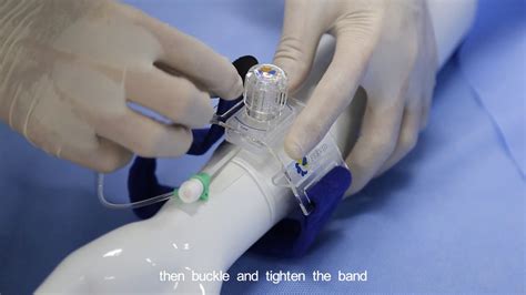 Radial Compression Hemostasis Device Youtube