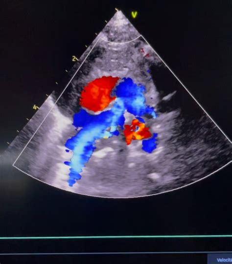 Chiara Culeddu On Linkedin Mapcas In Preterm Infant