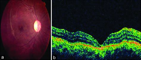 Traumatic Macular Hole Clinical Aspects And Controversies Latin