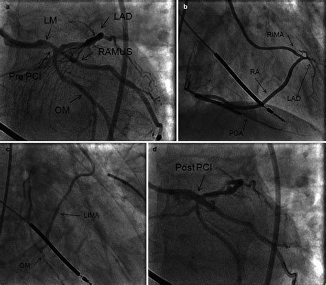 Hybrid Coronary Revascularization Thoracic Key