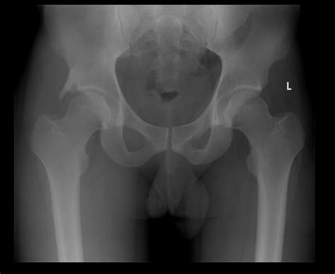 Subspine Impingement Ssi Physiopedia