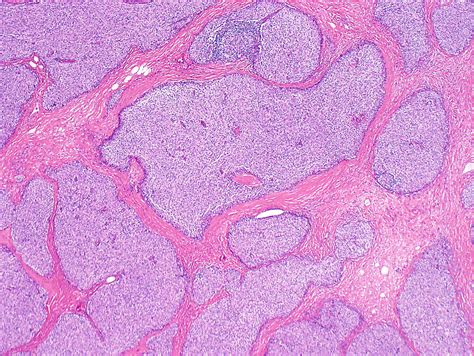 Pathology Outlines Thymoma