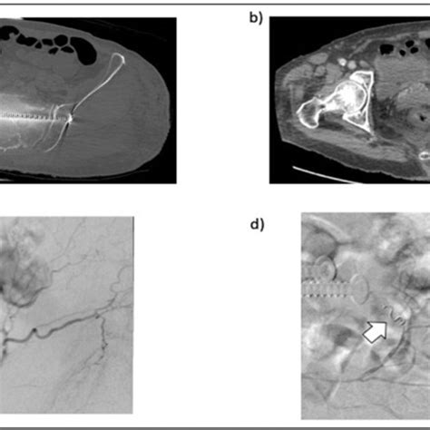 A B Pelvic Angiography Shows Active Arterial Bleeding From The