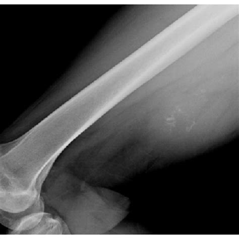 T2 Weighted Sagittal Mri Of The Thigh Demonstrating A Large Posterior