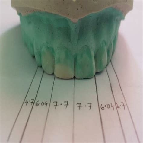 Pdf Smile Designing Using Recurring Esthetic Dental Proportion And