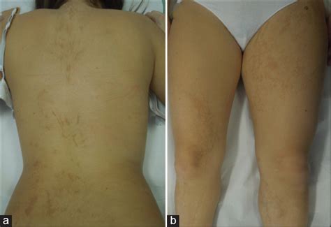 Linear And Whorled Nevoid Hypermelanosis A Case Report With Dermoscopic Findings Indian