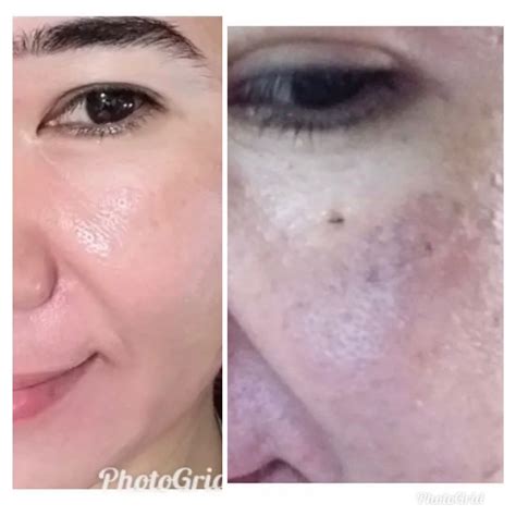 Buy Melasma Cream Remove Dark Sun Spot Acne Pimples Freckles Anti Aging