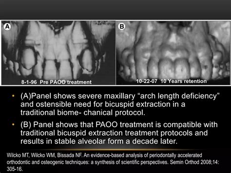 Corticotomy For Rapid Acceleration Pptx