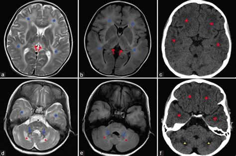 Giant Axonal Neuropathy Neurology India